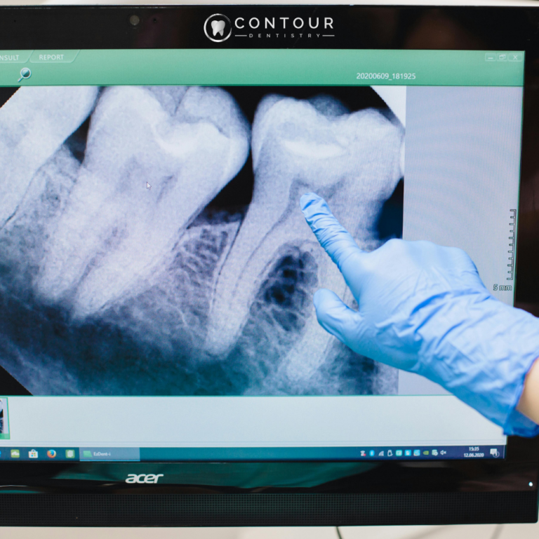 Understanding Dental X-Rays: Why They're Important and What They Reveal ...